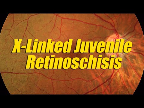 X linked Juvenile Retinoschisis | #shorts