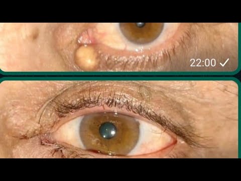 Medial Canthal Cyst