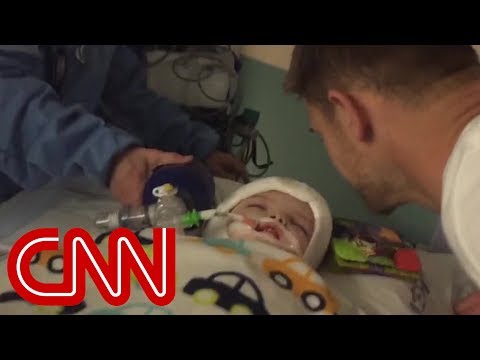 Conjoined twins after surgery: Separated and a success