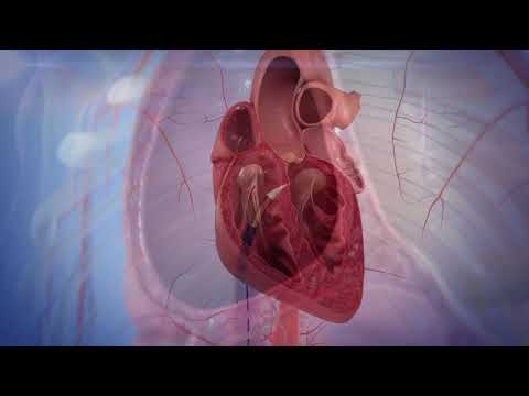 WATCHMAN Procedure