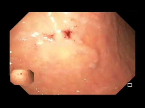 Stomach, Abnormal Post Surgical Anatomy, Gastric Ulcers Following Acute Early PEG Removal
