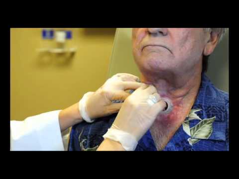 Demonstration on how to remove an adhesive base plate - for clinicians