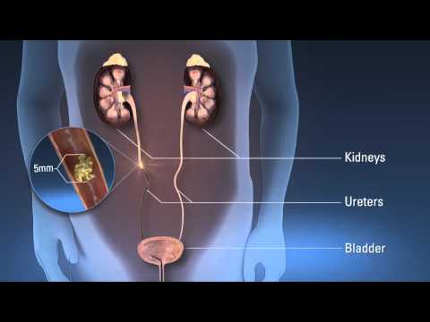 Ureteroscopy (URS)