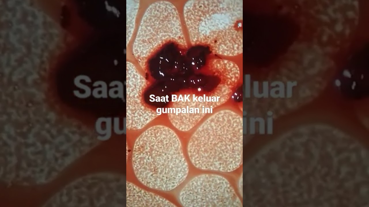 WAKTU KENCING KELUAR GUMPALAN DARAH