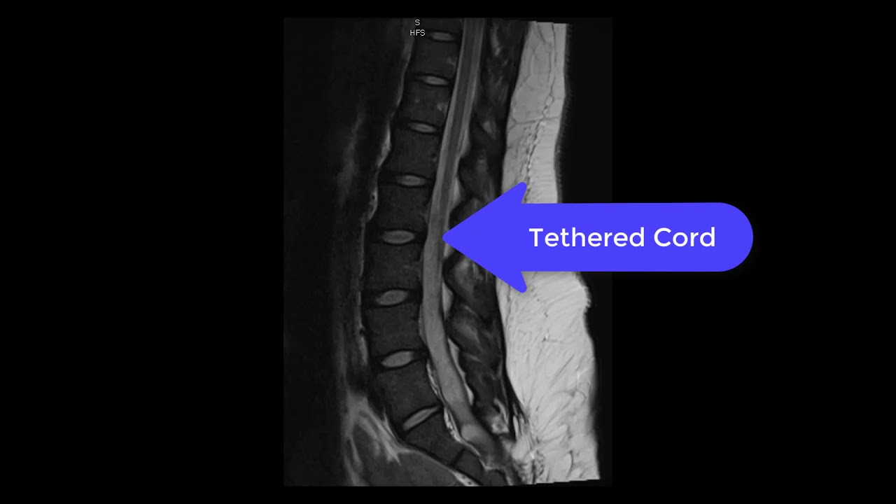 L-spine MRI, Spinal Bifida with Tethered Cord