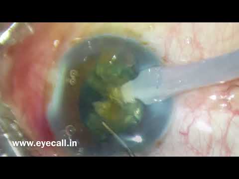 Small Pupil, Nuclear Sclerosis Grade 3- Phaco-Emulsification Cataract Surgery #4
