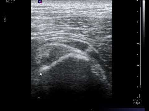 Ischial bursa injection