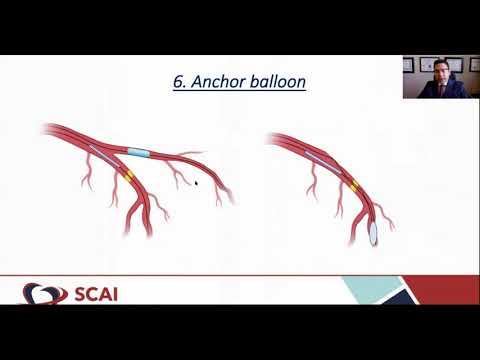 #SCAI2021 - Ups & Downs of #Coronary #Tortuosity: Uncomplicating the complex - Hady Lichaa, MD