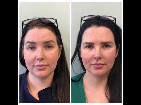 Botox Before and After