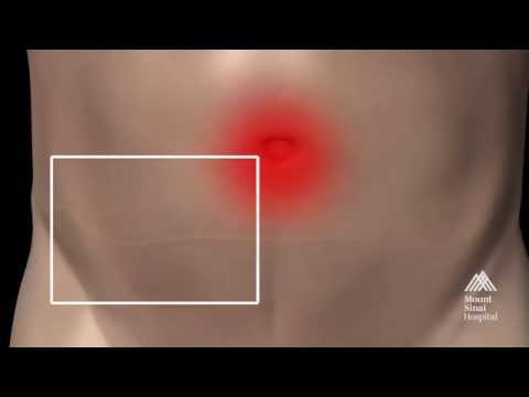 The Mount Sinai Surgical Film Atlas Laparoscopic Appendectomy