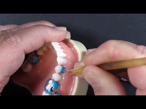 BlueView™ Cervical Matrices Kit | Garrison Dental