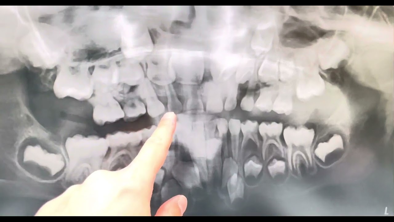 Explaining a child’s dental panoramic X-ray