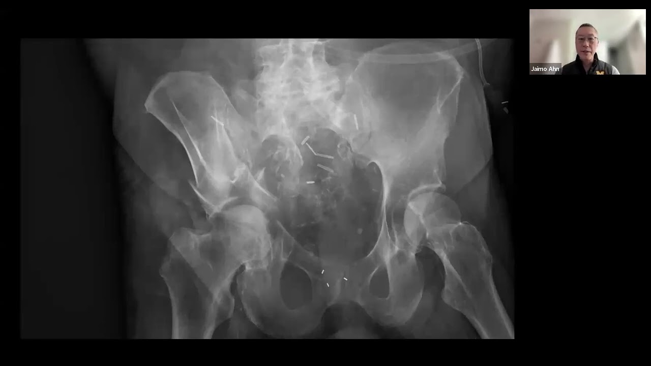 Protrusio Acetabular Fractures - Jaimo Ahn, M.D. | HOGR-HUP 2024