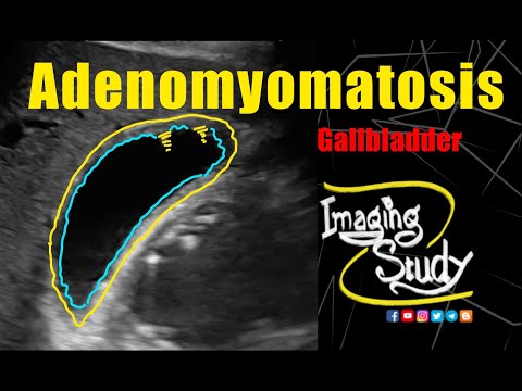 Adenomyomatosis of Gallbladder || Ultrasound || Case 336
