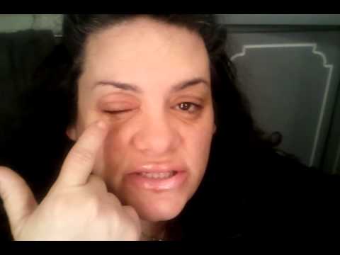 Resin Allergic Reaction..be aware!!!