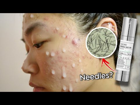 VT Cosmetics Reedle Shot Review on Acne prone skin (1 Week)