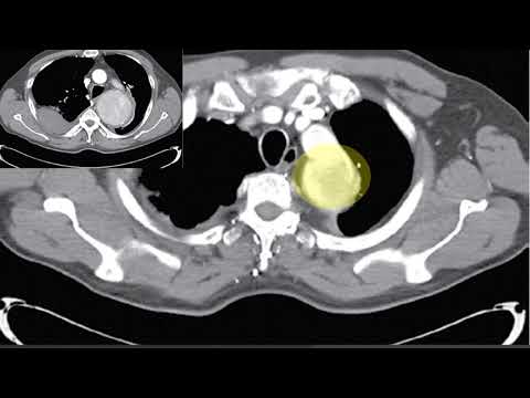 Patient is haemodynamically stable at present
