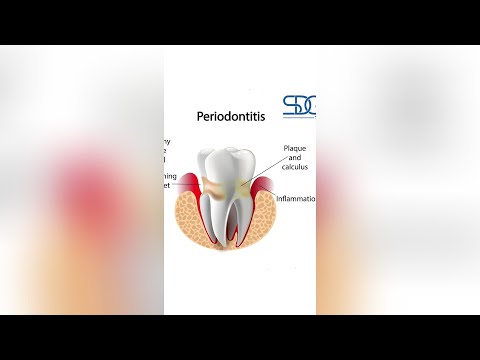 Types Of Treatment For Periodontal Disease