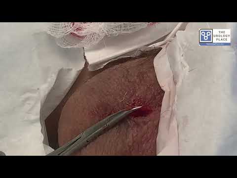 No Needle No Scalpel Vasectomy in San Antonio, Texas with Dr Kella. Step by Step Instructions