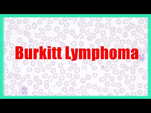 Burkitt lymphoma made easy | Speedy Medical Hematology |