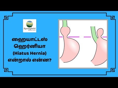 ஹையாட்டஸ் ஹெர்னியா என்றால் என்ன? Hiatus Hernia in Tamil by Dr Maran, Hernia Surgeon in Chennai