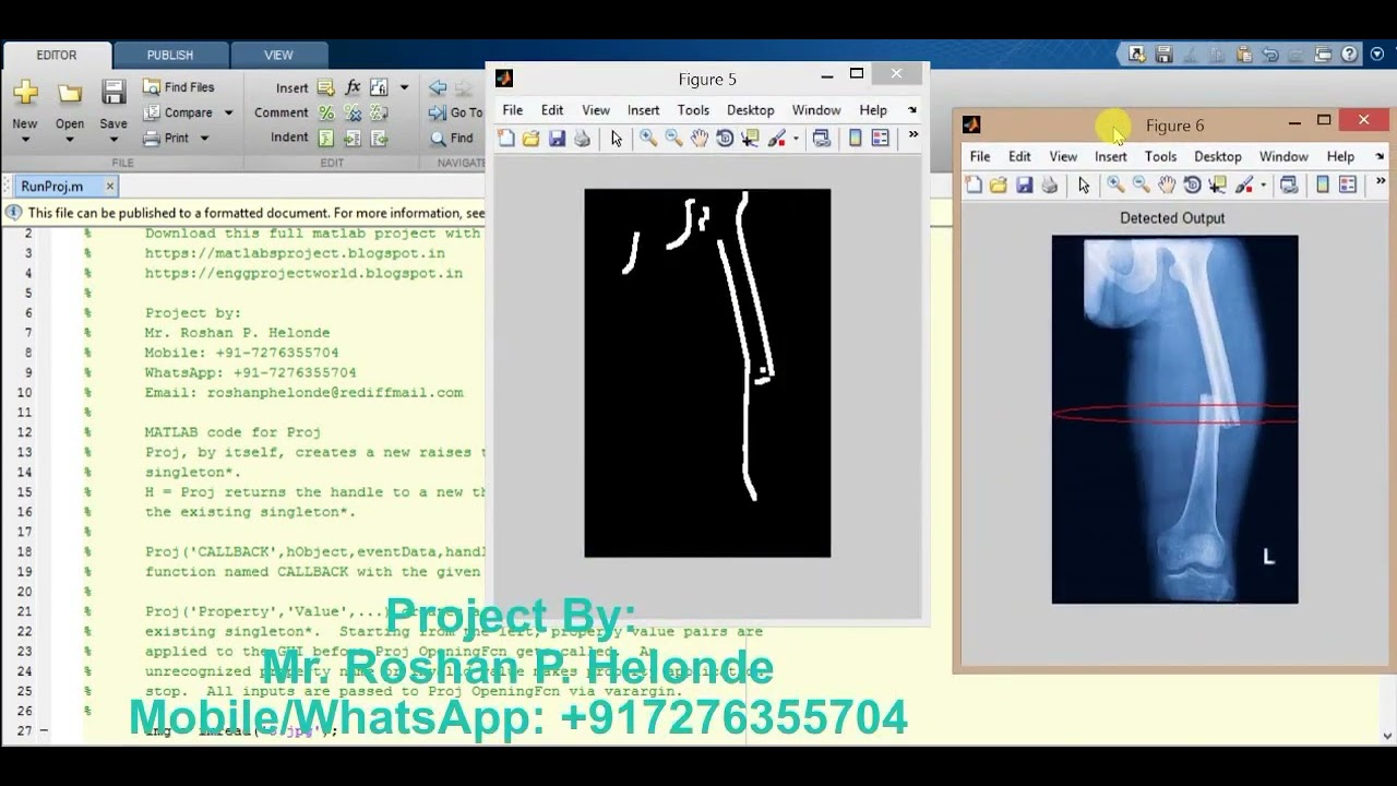 Bone Fracture Detection Using Image Processing Matlab Project With source Code