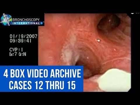 Bronchoscopy EBUS TBNA - 4 Box Video Archive cases 12 thru 15