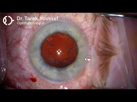 Cataract Surgery 20250612 123947 Video23 by Dr Youssef x264