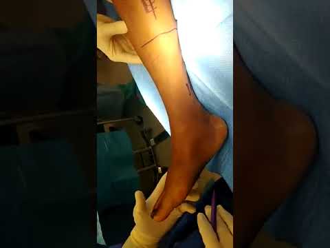 Orthoplastic Approach to Baumann, Tibialis Posterior Tendon and Tibialis Anterior Tendons