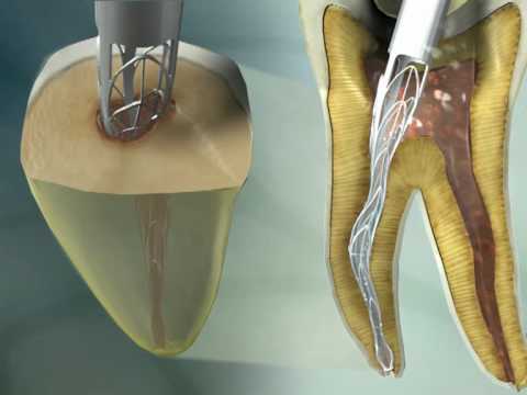 ReDent Nova- root canal treatment (SAF innovative device)produced by Virtual Point