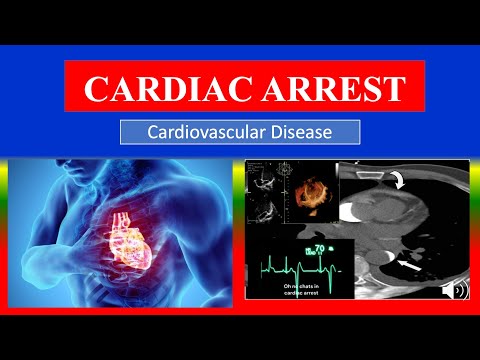 CARDIAC ARREST - Definition, types, causes, pathophysiology, symptoms , diagnoses , medicine