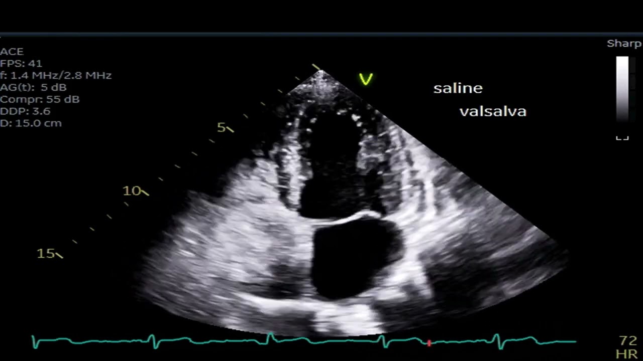 Negative Saline Bubble Study