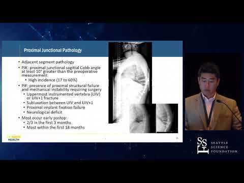Adult Spinal Deformity Surgery Complication Prevention Kee D Kim, MD