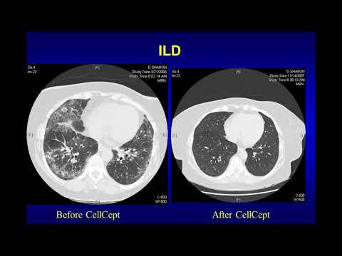 New and Emerging Treatments in Dermatomyositis