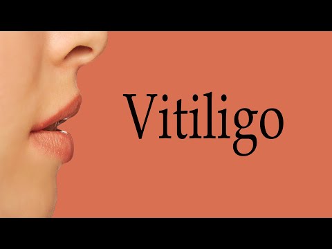 How To Say Vitiligo