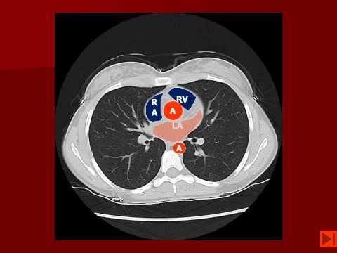 Normal Chest CT with labels