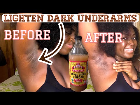 HOW TO LIGHTEN DARK UNDERARM PERMANENTLY | APPLE CIDER FOR DARK UNDERARMS