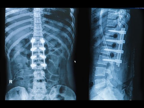 Arthrodesis Anterior technique CPT code - simplify medical coding