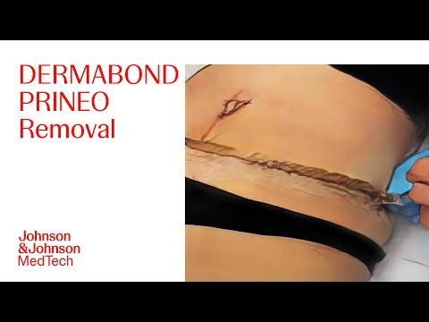 Correct Way to Remove DERMABOND PRINEO Skin Closure System | J&J MedTech