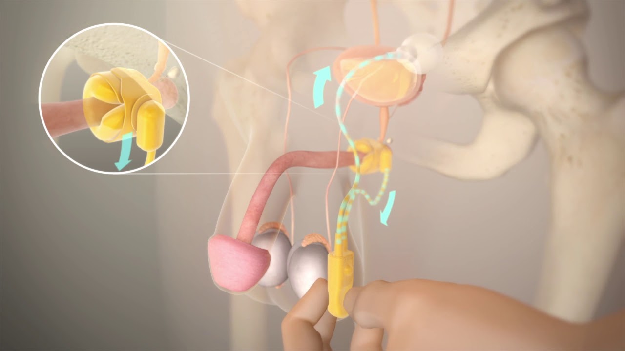 Post Prostatectomy (Part 07): The Artificial Sphincter