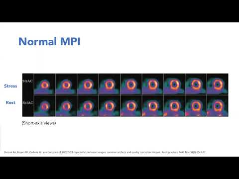 Fast Facts - MPI and Balanced Ischemia