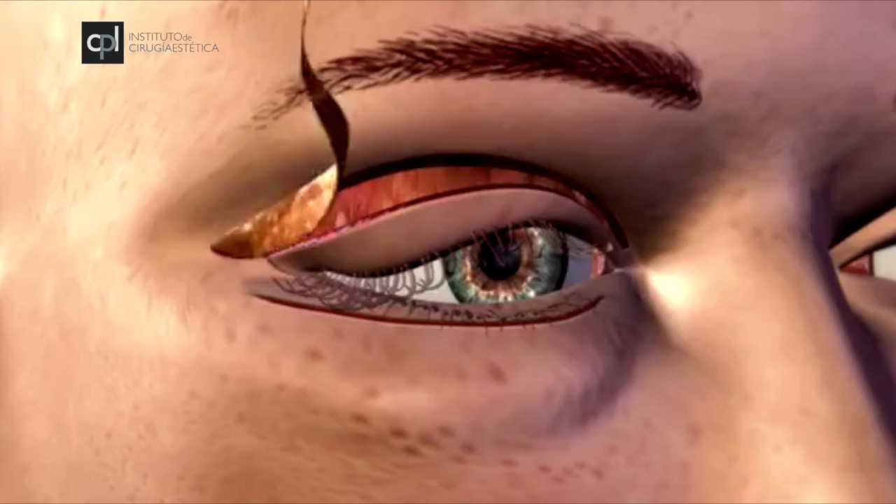 Cirugía de los párpados. Blefaroplastia