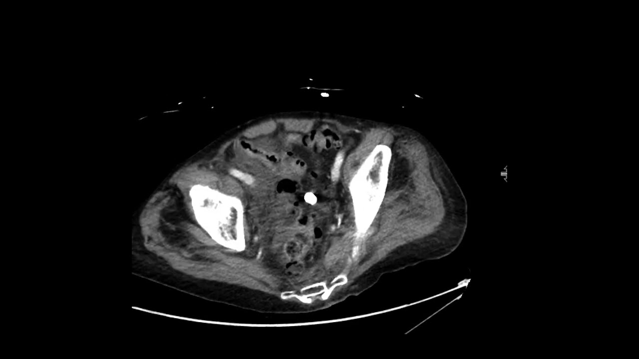 Retroperitoneal hematoma with active extravasation