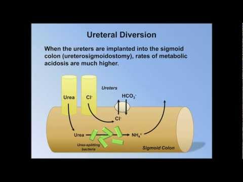 Normal Anion Gap Metabolic Acidosis (ABG Interpretation - Lesson 9)
