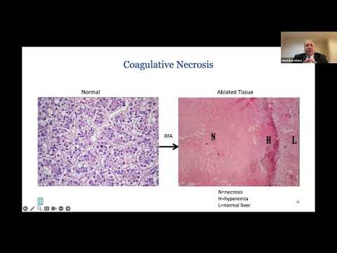 Dr. Arellano: How ablation can be a cancer terminator