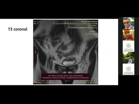 Mayer Rokitansky Kuster Hauser syndrome