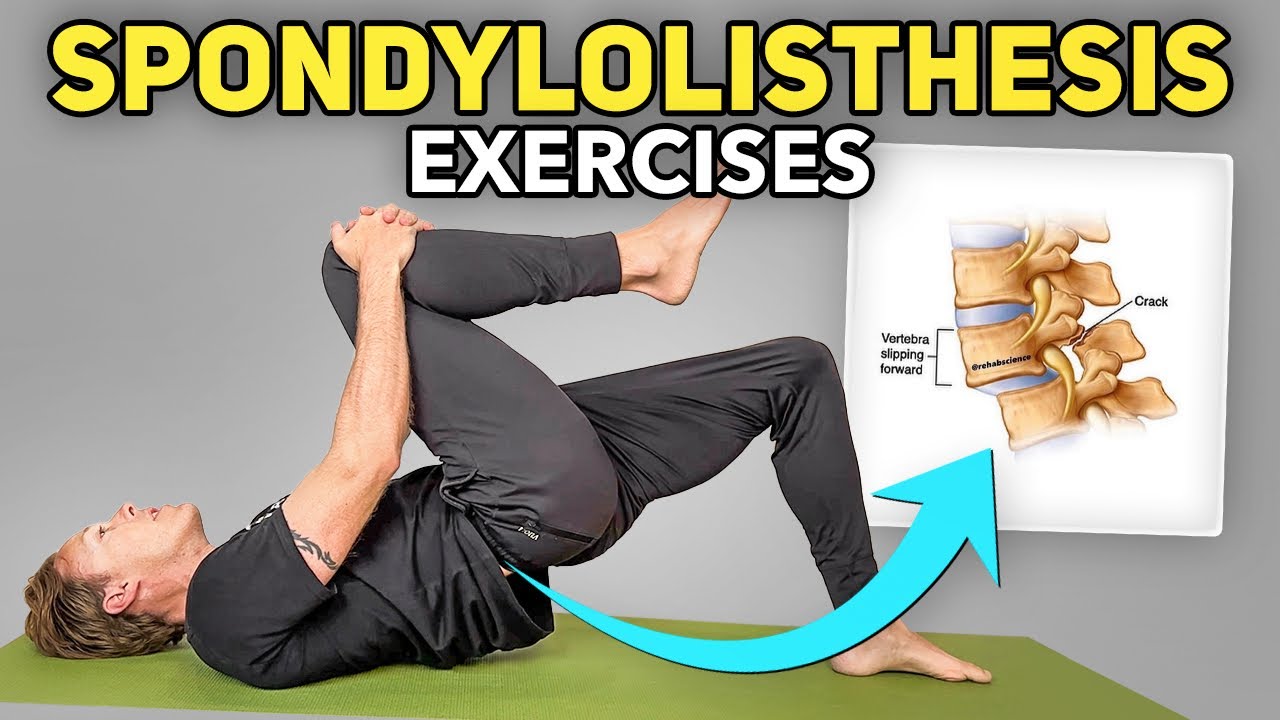 5 Exercises for Lumbar Spondylolisthesis