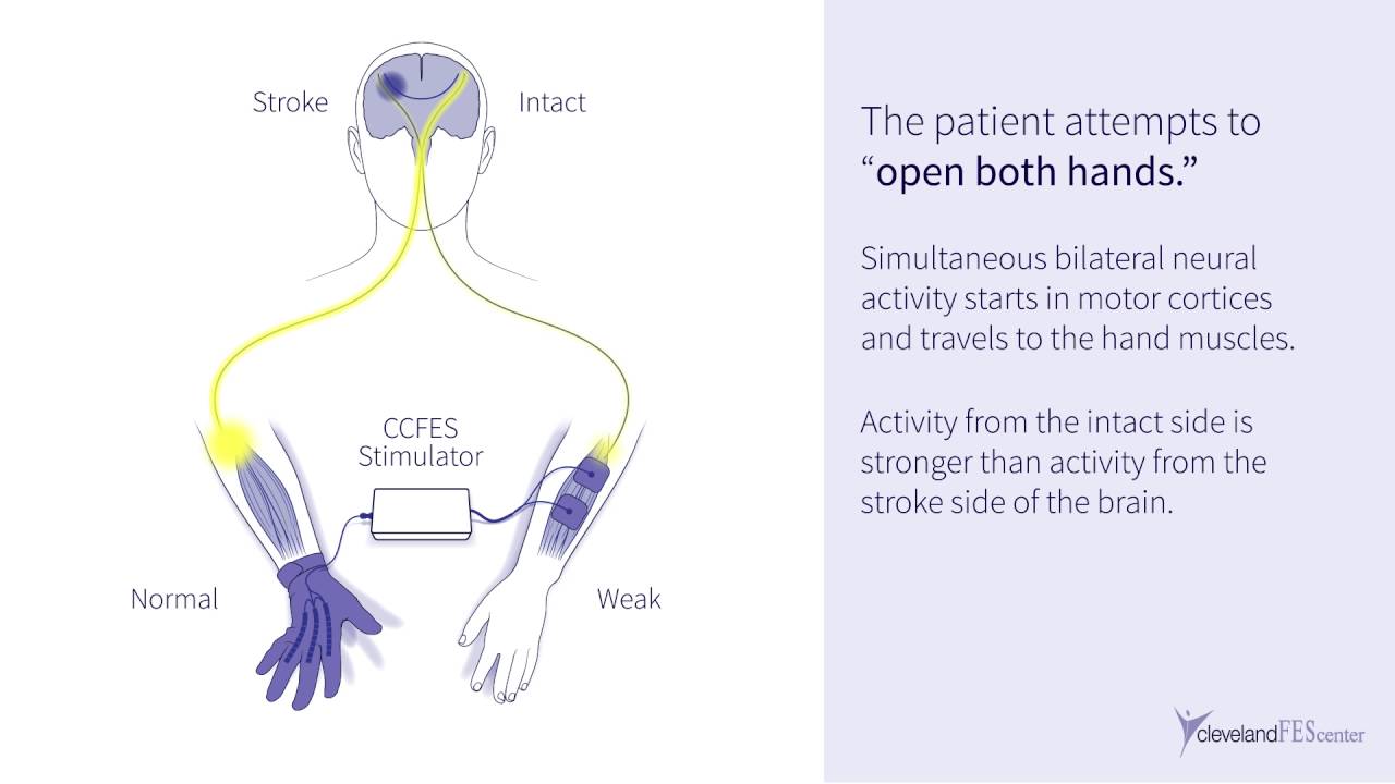 Contralaterally Controlled Functional Electrical Stimulation (CCFES)
