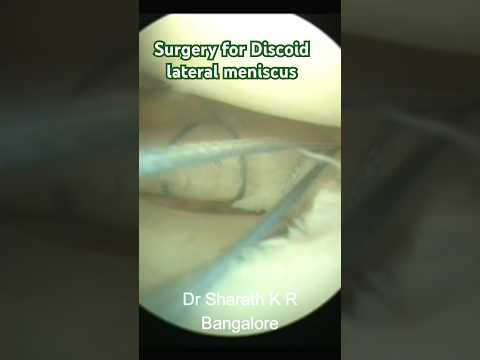 Discoid lateral meniscus surgery.#arthroscopicsurgeon #bestkneereplacementsurgeon #kneearthroscopy