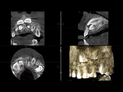 Three supernumerary teeth in ant mx
